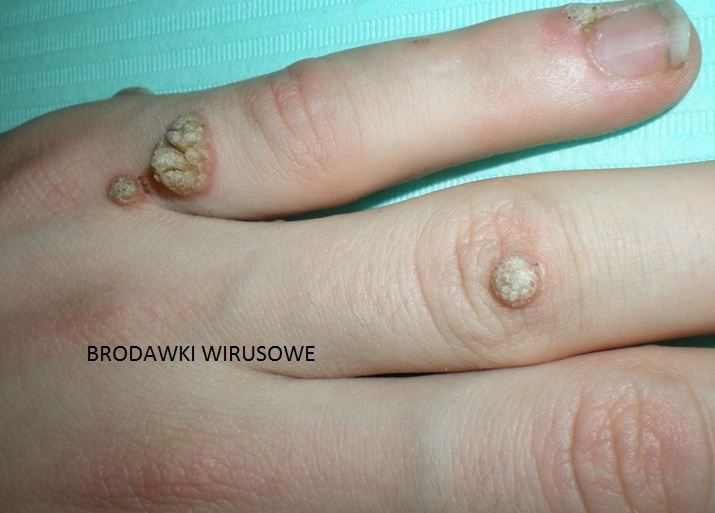 Elektrochirurgia | Dermcenter